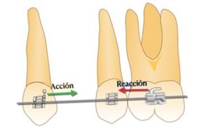 Anclaje en Ortodoncia I - Micro-Implantes - Dra. Hernández Pando